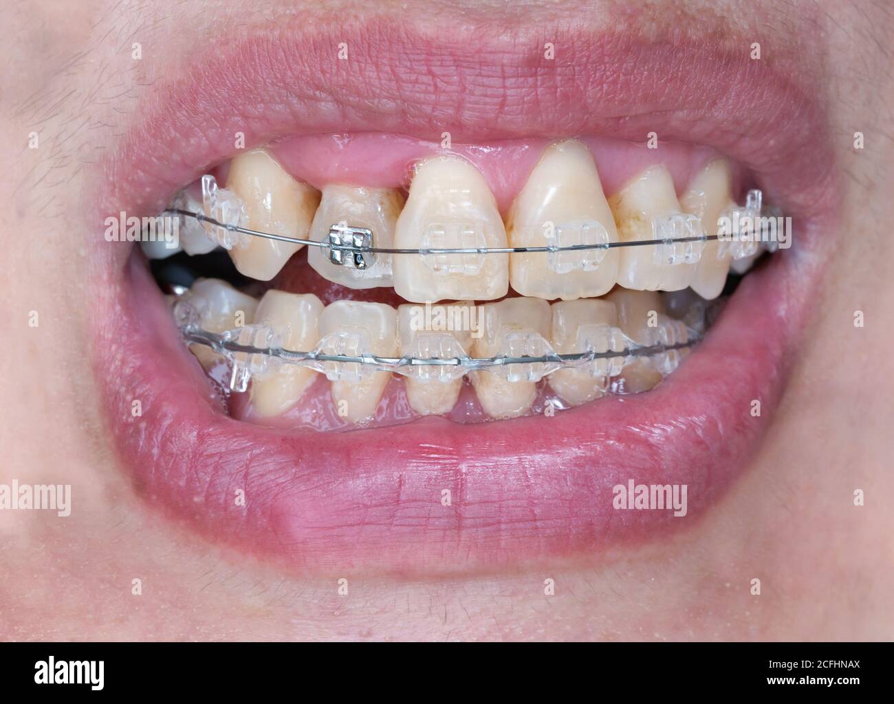Crooked Teeth With Braces