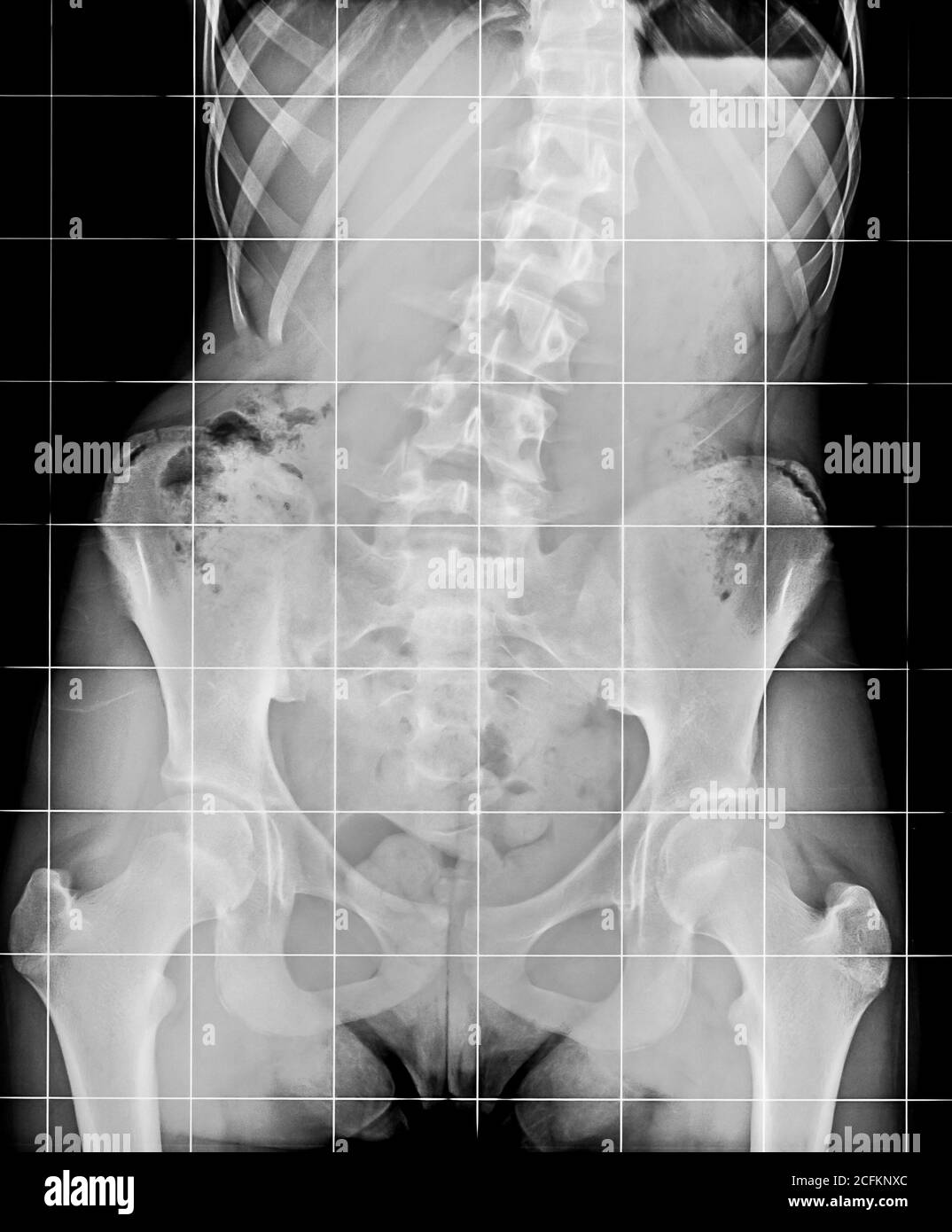 Mri pelvis Black and White Stock Photos & Images - Alamy