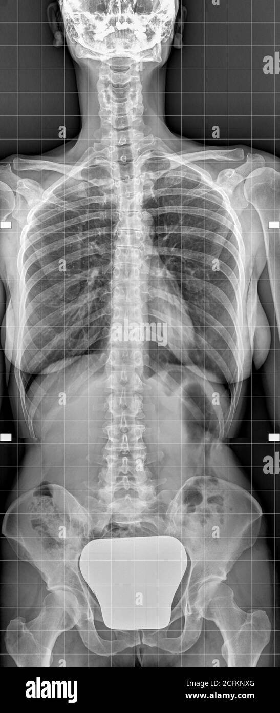 X-Ray Imaging of female Spinal Column Stock Photo - Alamy