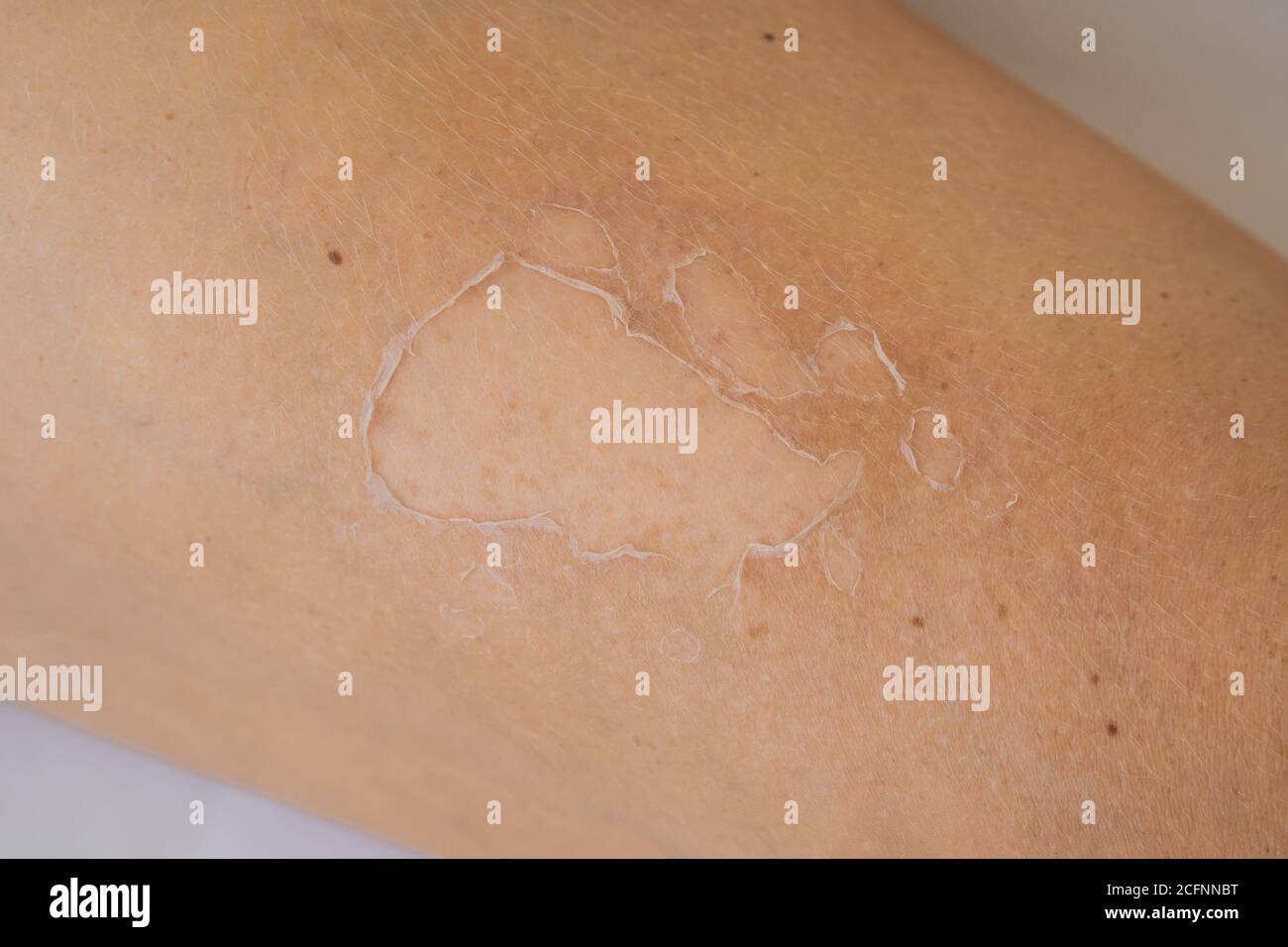 Peeling Skin High Resolution Stock Photography and Images - Alamy