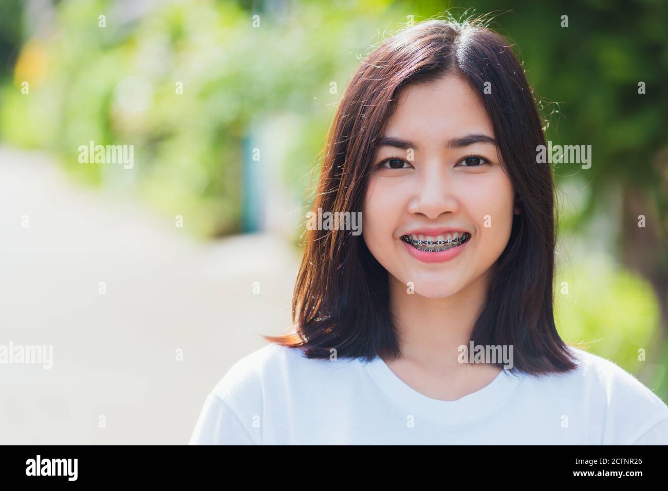 Portrait of Asian teen beautiful young woman smile have dental braces ...