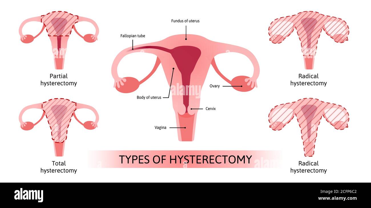 Hysterectomy Surgical Removal Of The Uterus Medical Vector