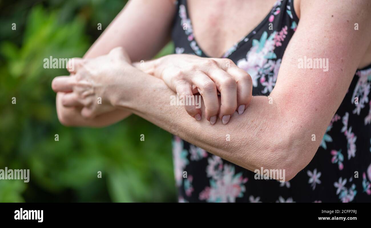 Stressed woman scratching itchy hi-res stock photography and images - Alamy