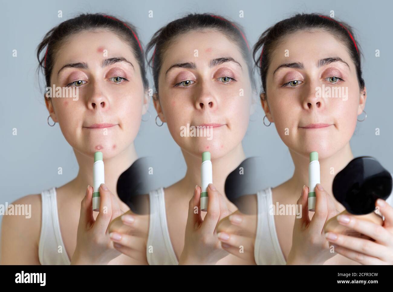 Rash face hi-res stock photography and images - Alamy