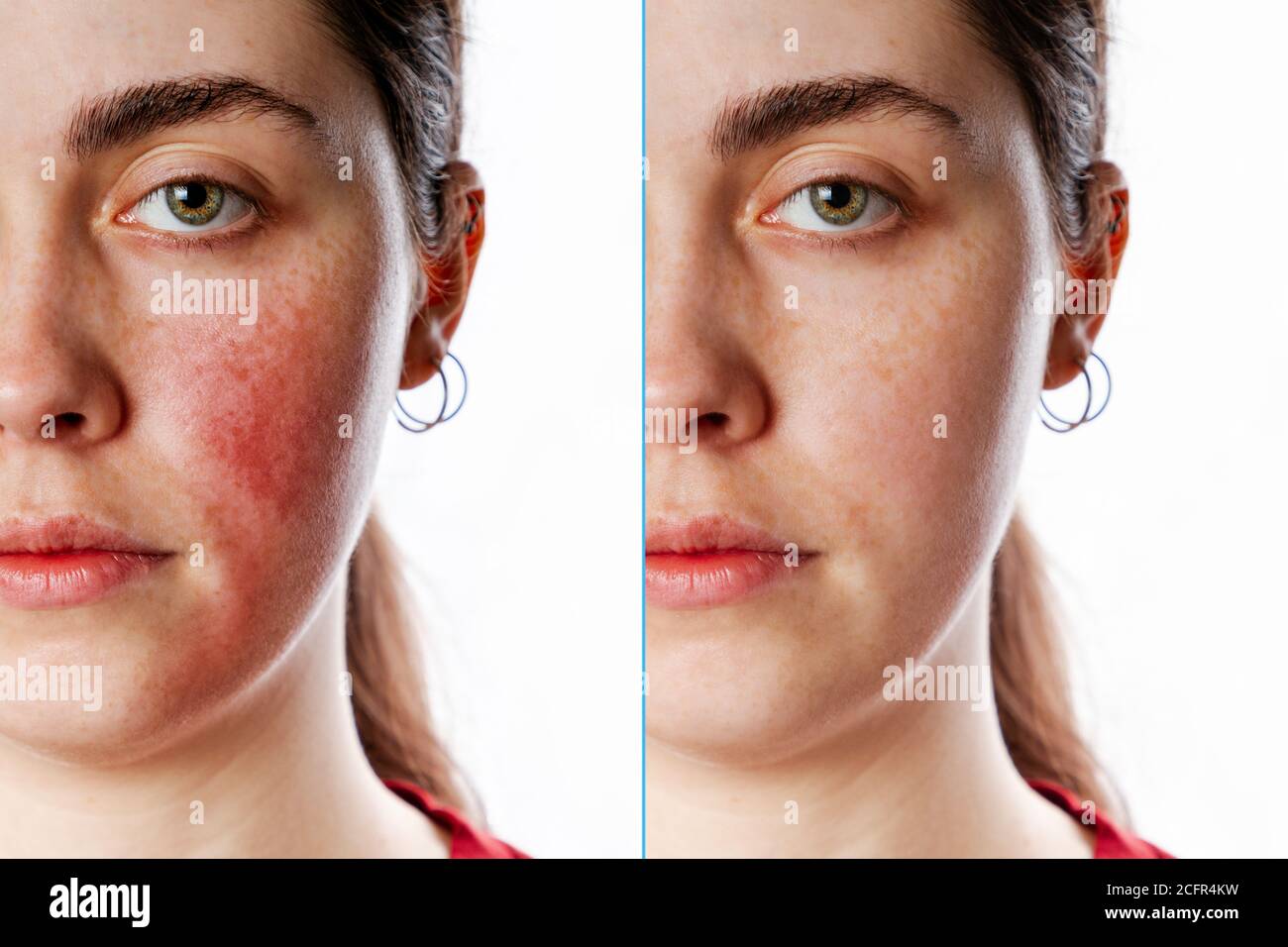 A close-up portrait of a young Caucasian woman showing redness and ...
