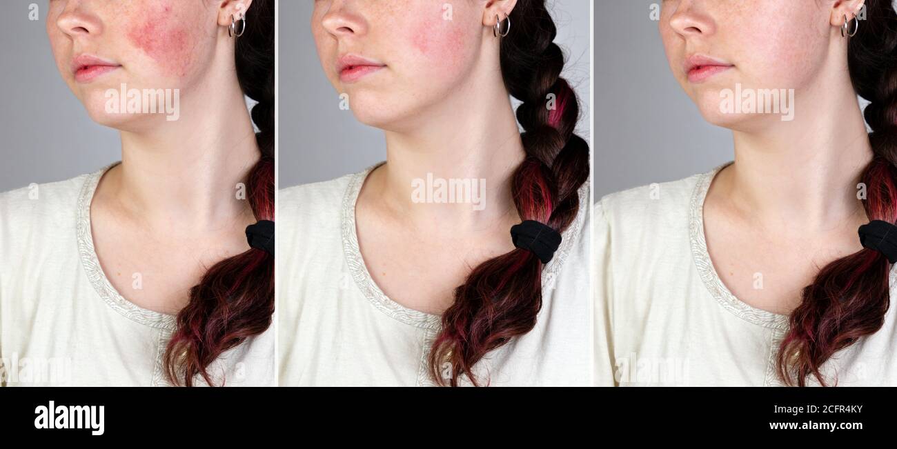 A series of images of a young Caucasian woman's face showing redness ...