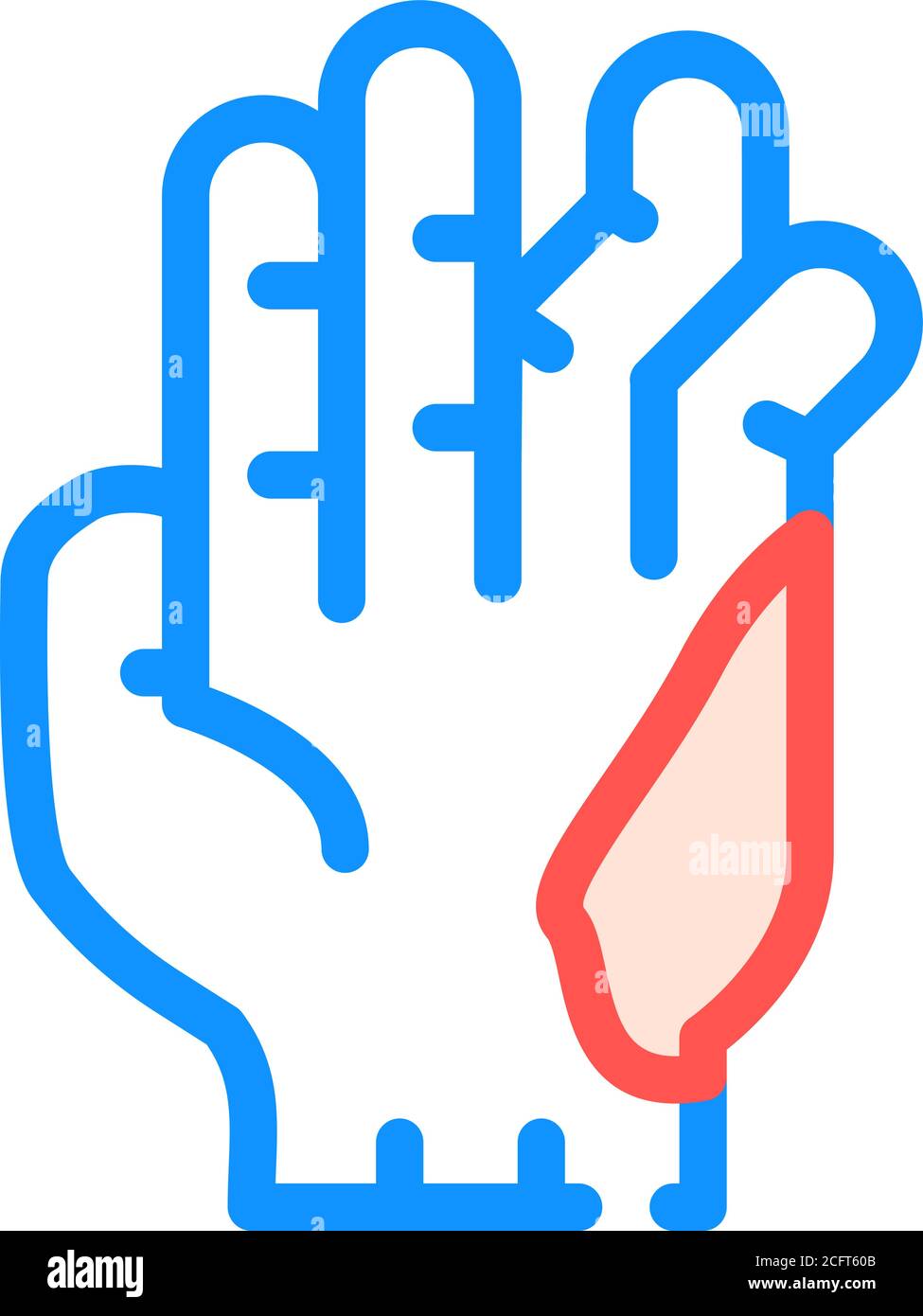 Displaced fracture hi-res stock photography and images - Alamy