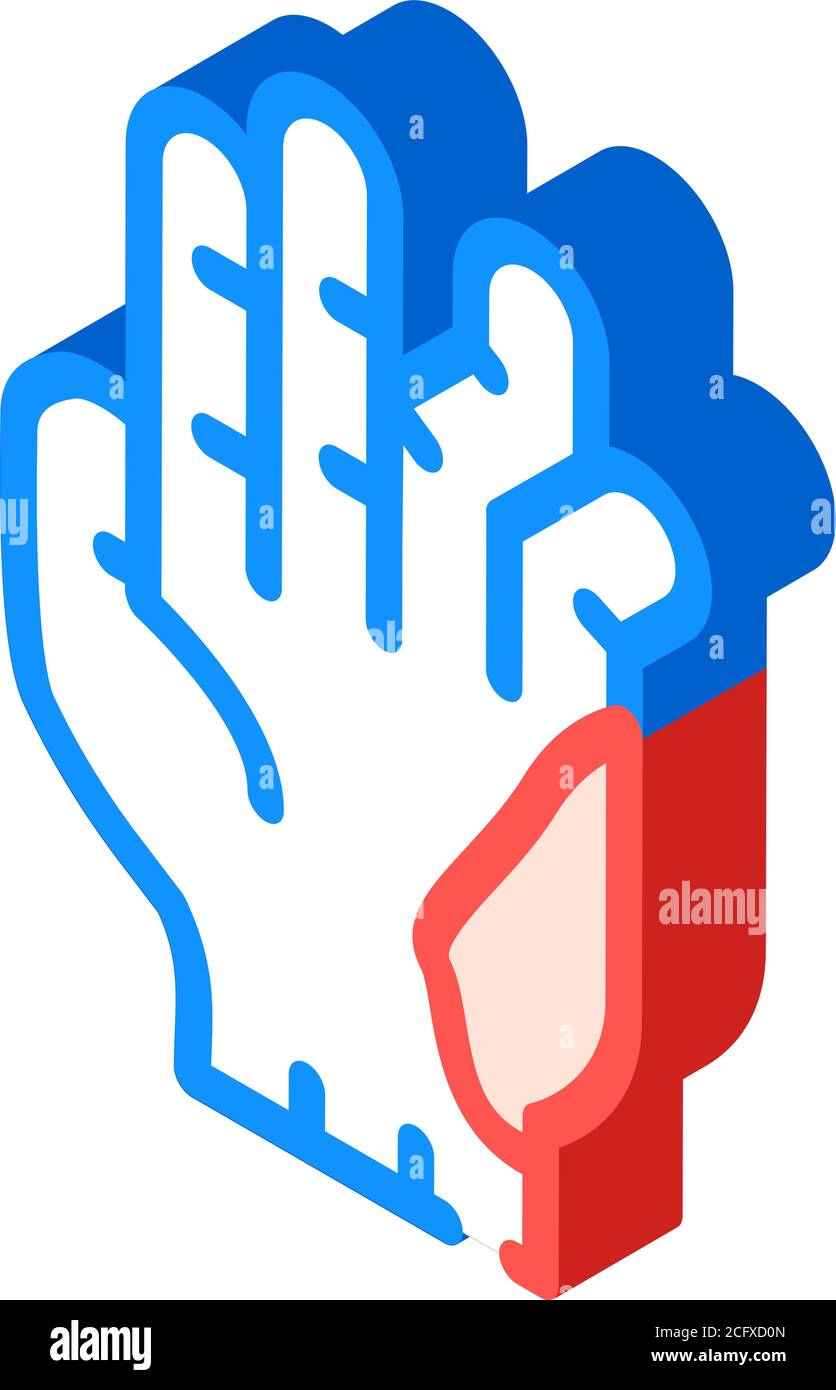 displaced fracture isometric icon vector isolated illustration Stock ...