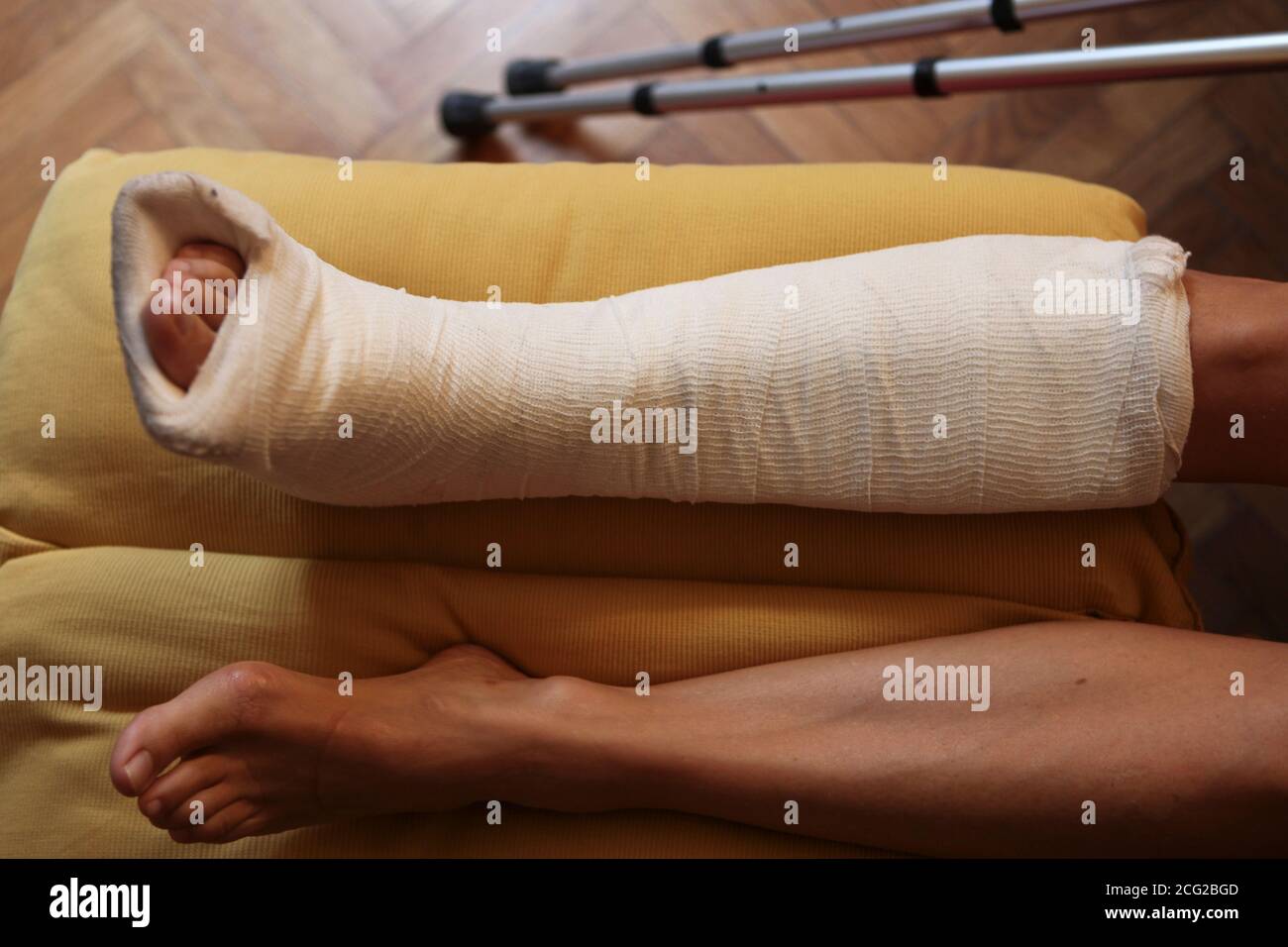 woman with one leg in plaster Stock Photo - Alamy