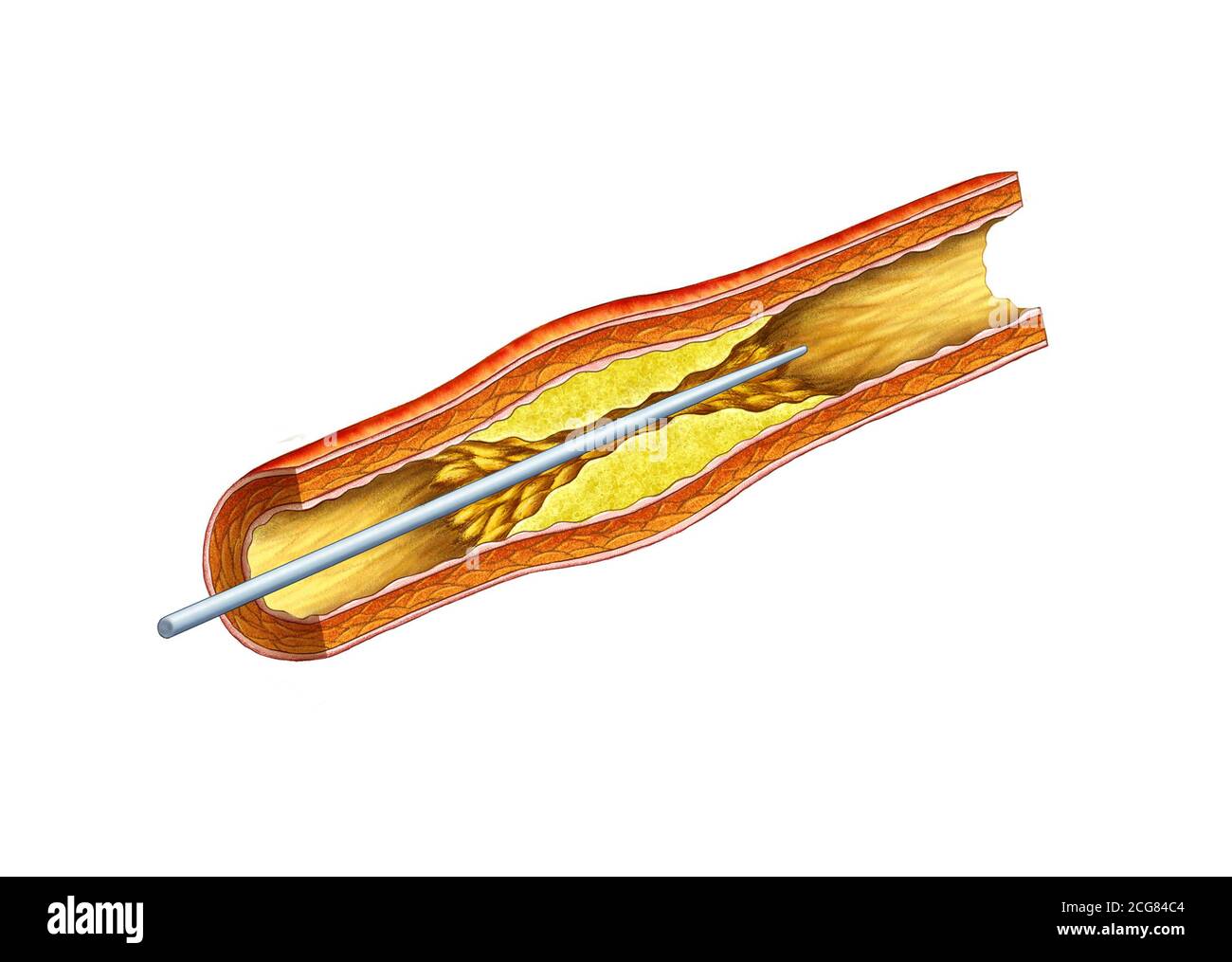 anatomical illustration of vascular stent procedure Stock Photo - Alamy