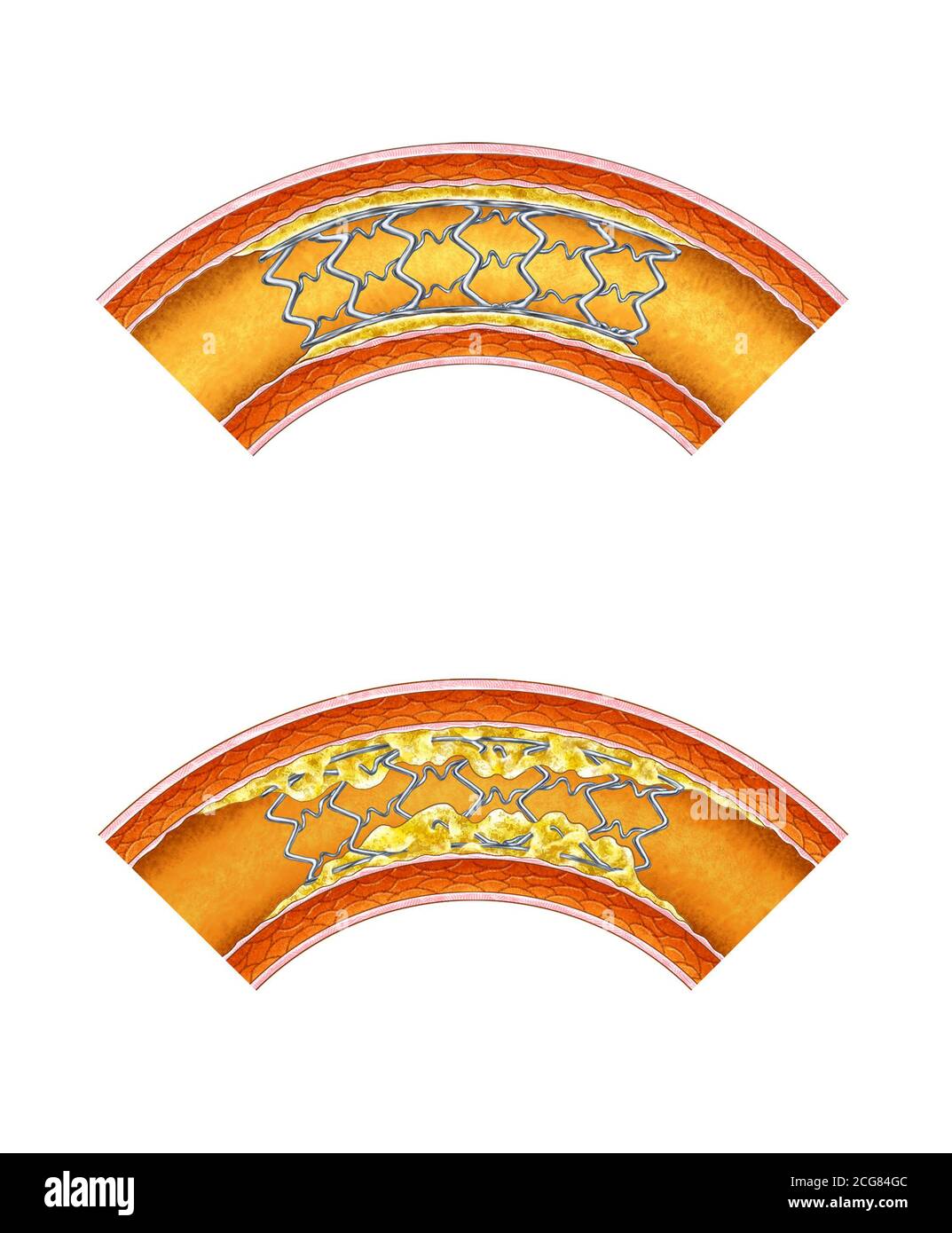 anatomical illustration of vascular stent procedure Stock Photo - Alamy