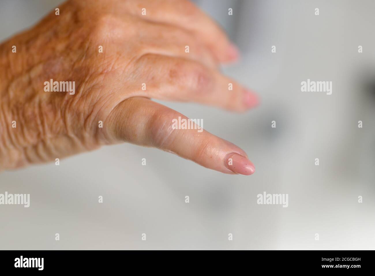 Swelling fracture hi-res stock photography and images - Alamy