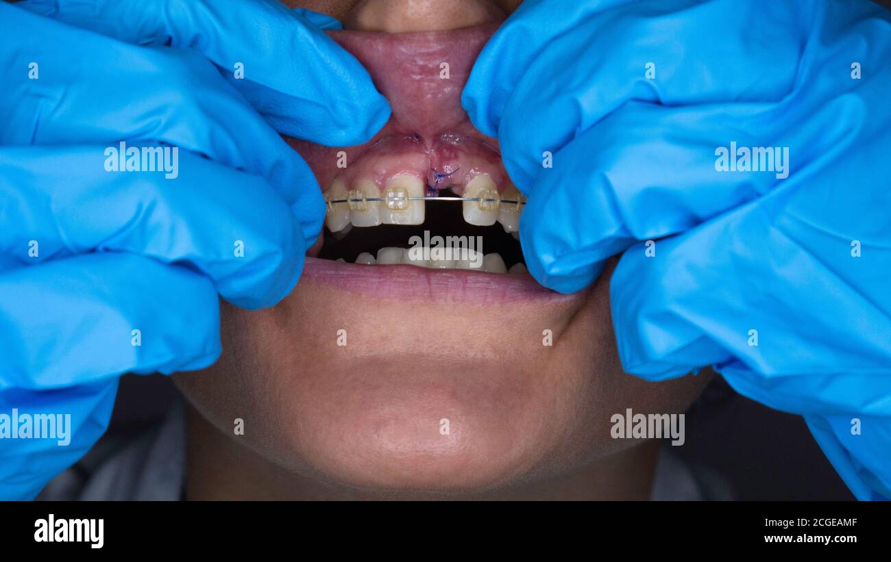 Sutured wound in the mouth after implant placement. Dental implants ...
