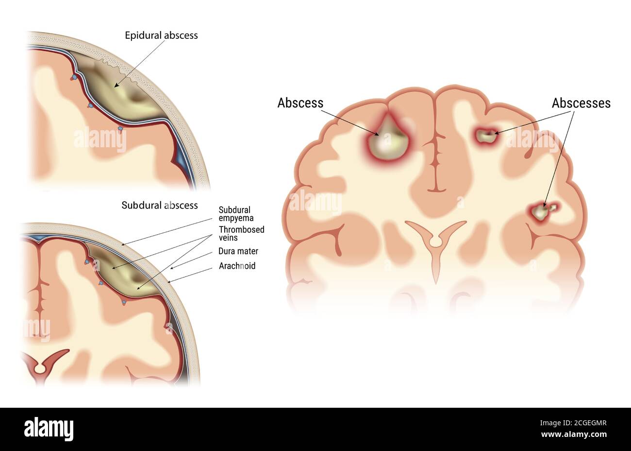 Abscess set vector Stock Vector Image & Art - Alamy