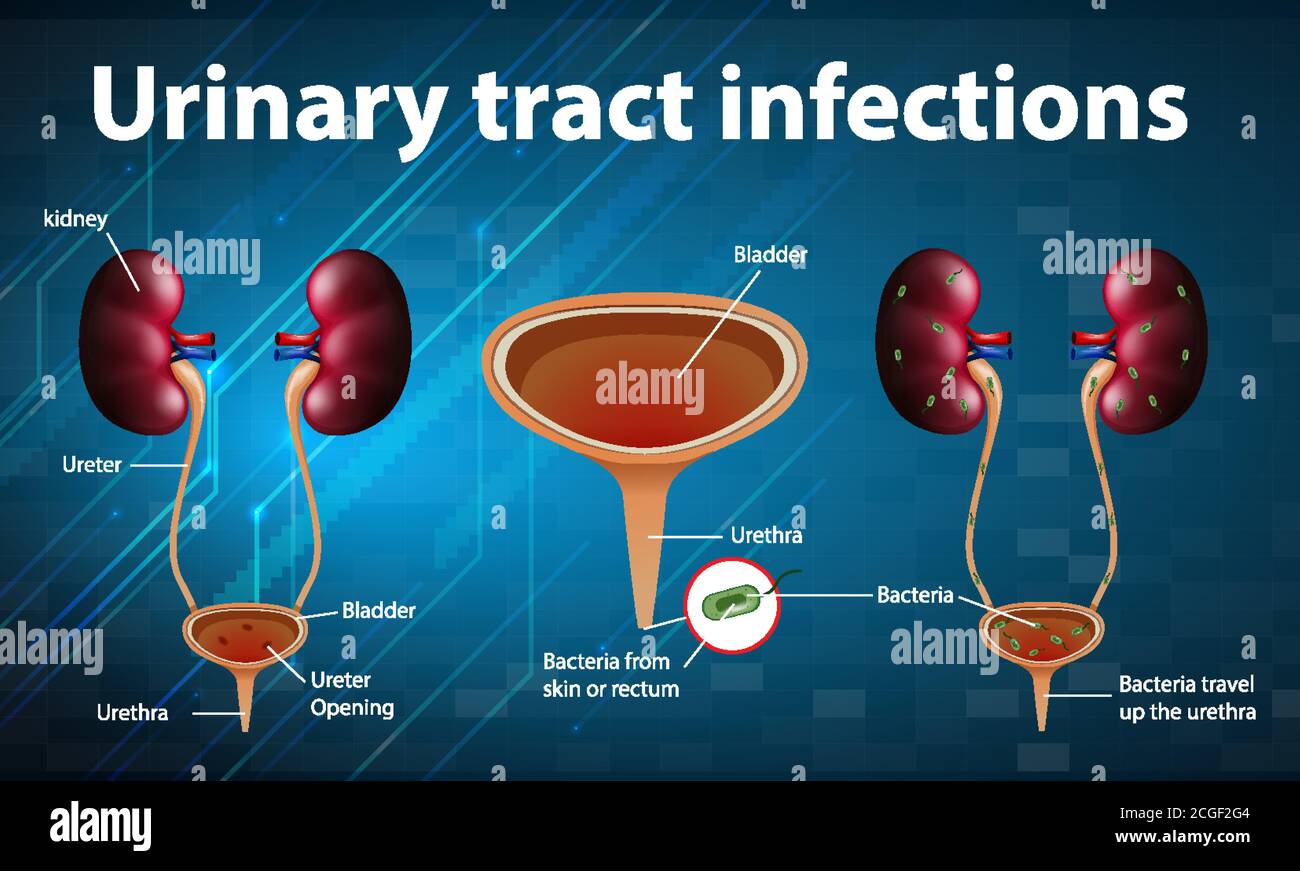 Urinary Tract High Resolution Stock Photography and Images - Alamy