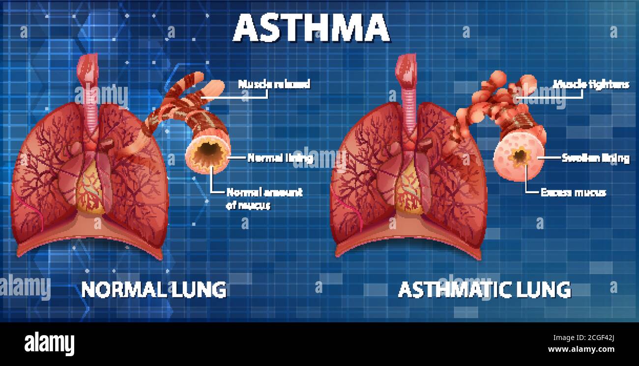 Normal Lung High Resolution Stock Photography and Images - Alamy