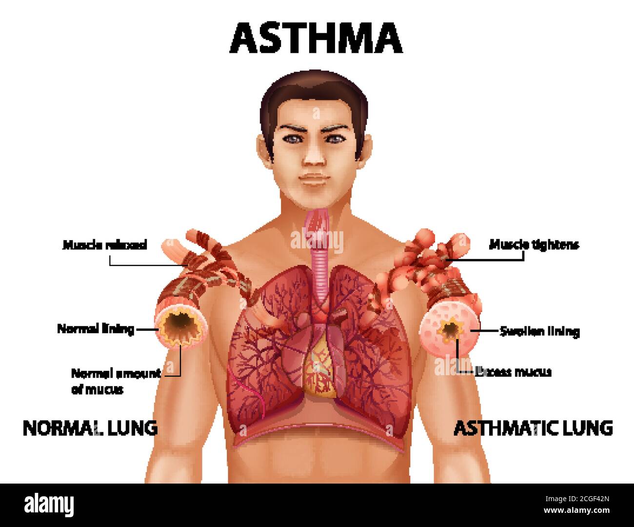 Comparison Of Healthy Lung And Asthmatic Lung Illustration Stock Vector