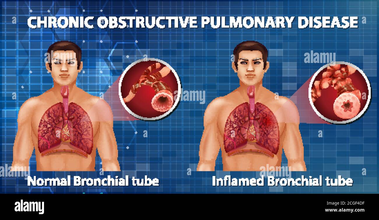 Chronic obstructive pulmonary disease illustration Stock Vector Image ... Chronic obstructive pulmonary disease illustration Stock Vector Image ...