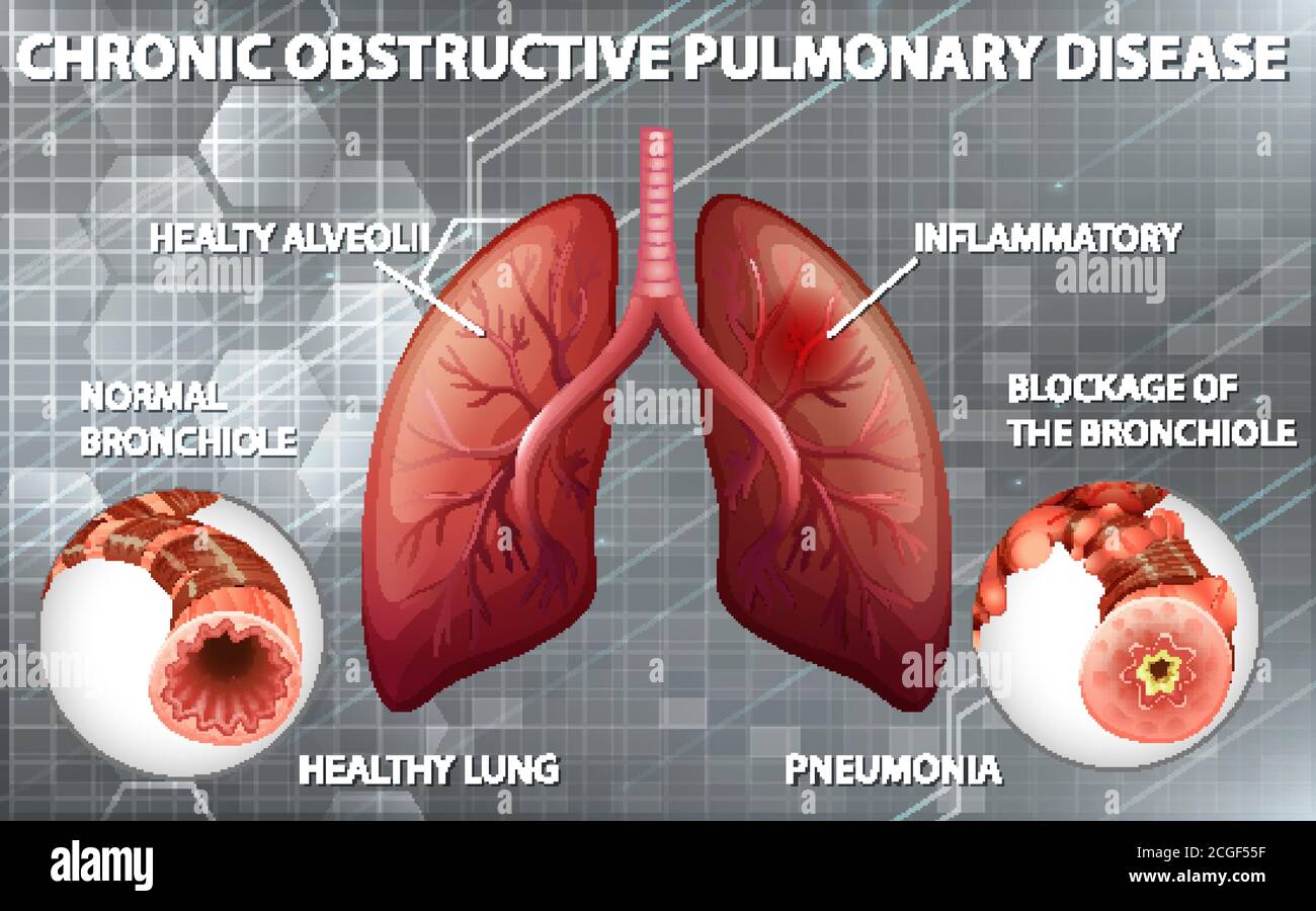 Chronic Obstructive Pulmonary Disease High Resolution Stock Photography ...