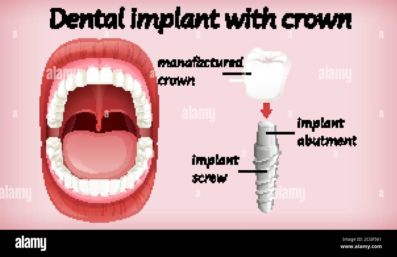 Dental implant with crown illustration Stock Vector Image & Art - Alamy