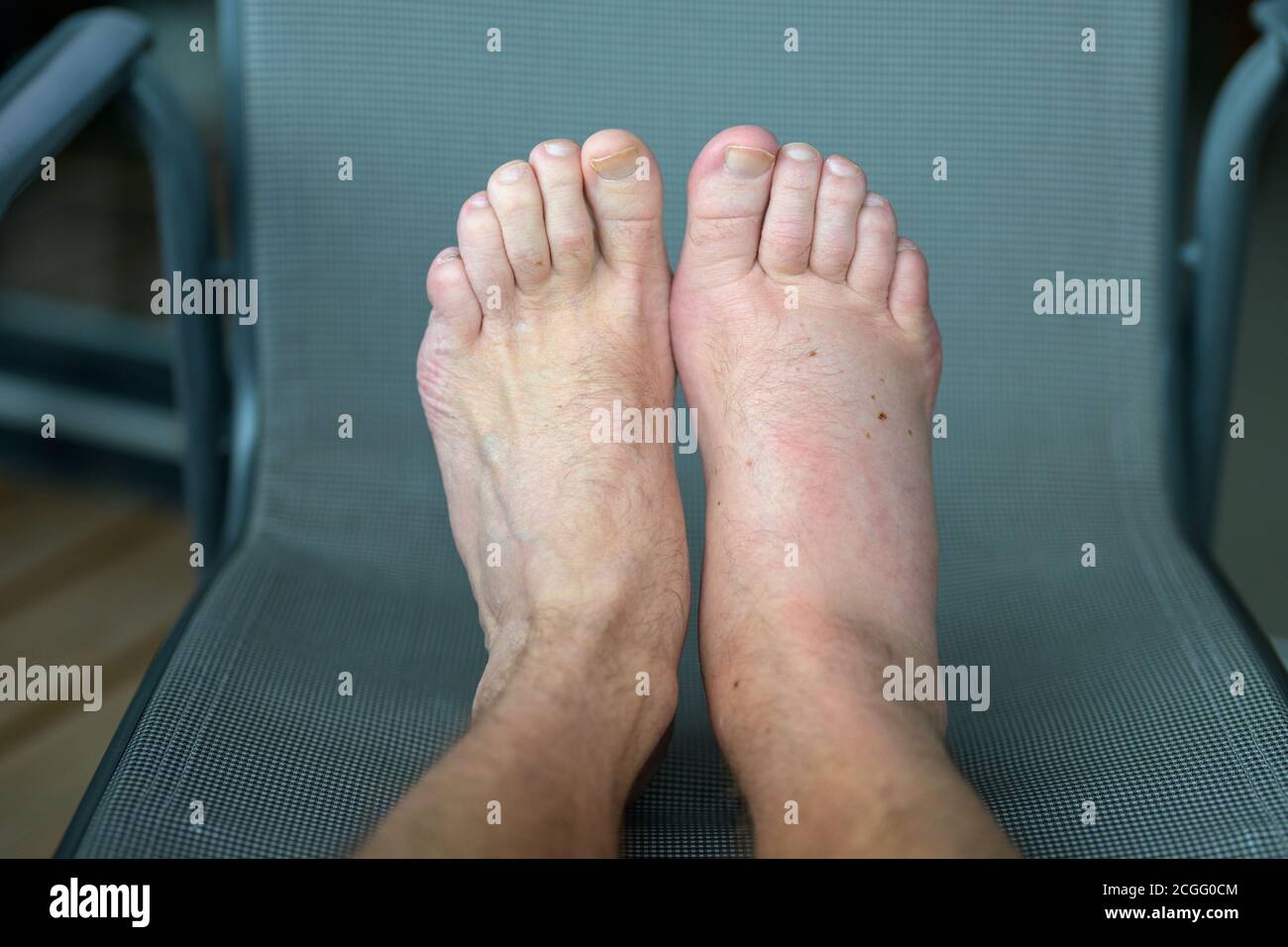Man showing an allergic immune reaction to an insect sting with his ...