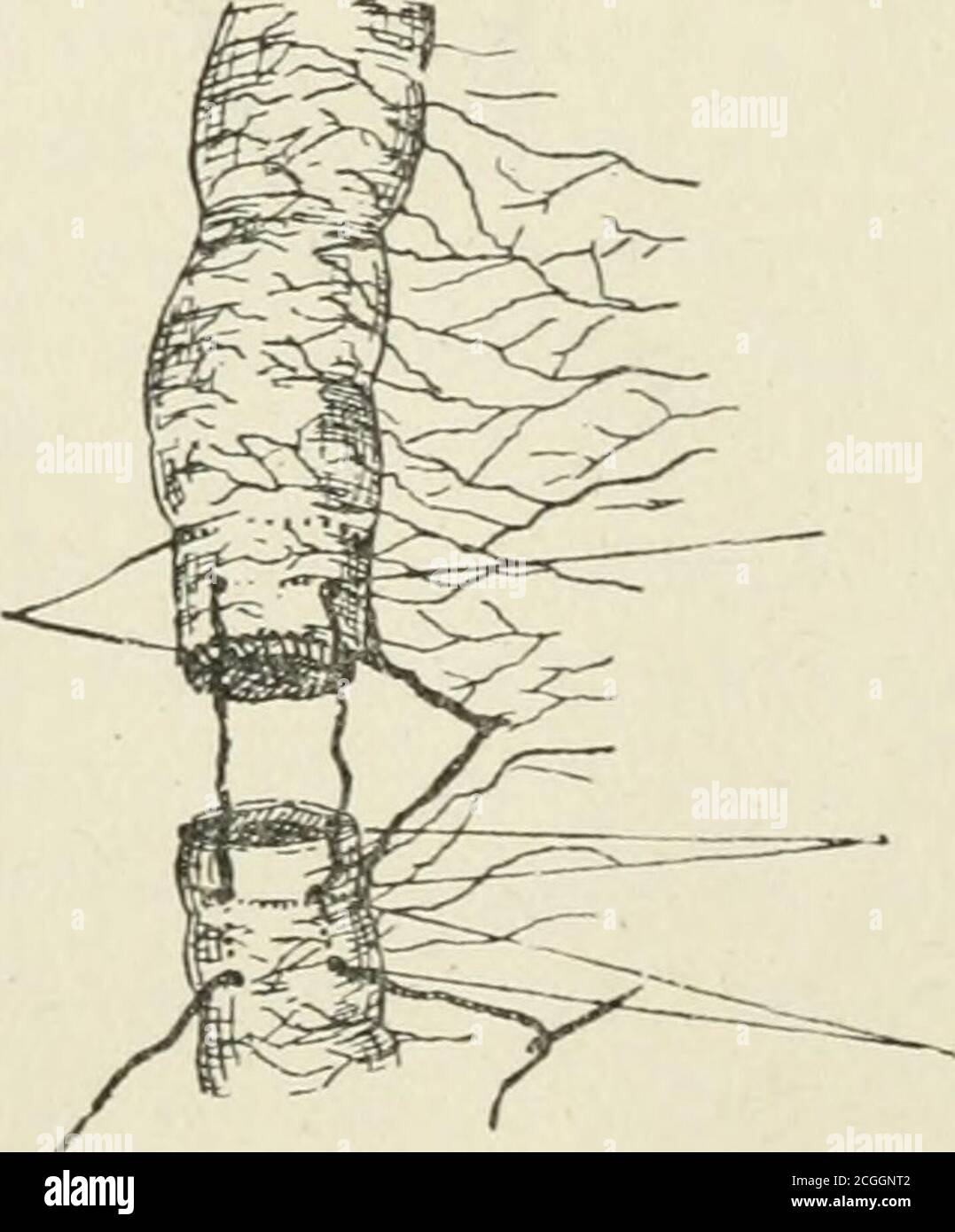 . Annals of surgery . Intestinal Anastomosis by Perforated Decalcified ...