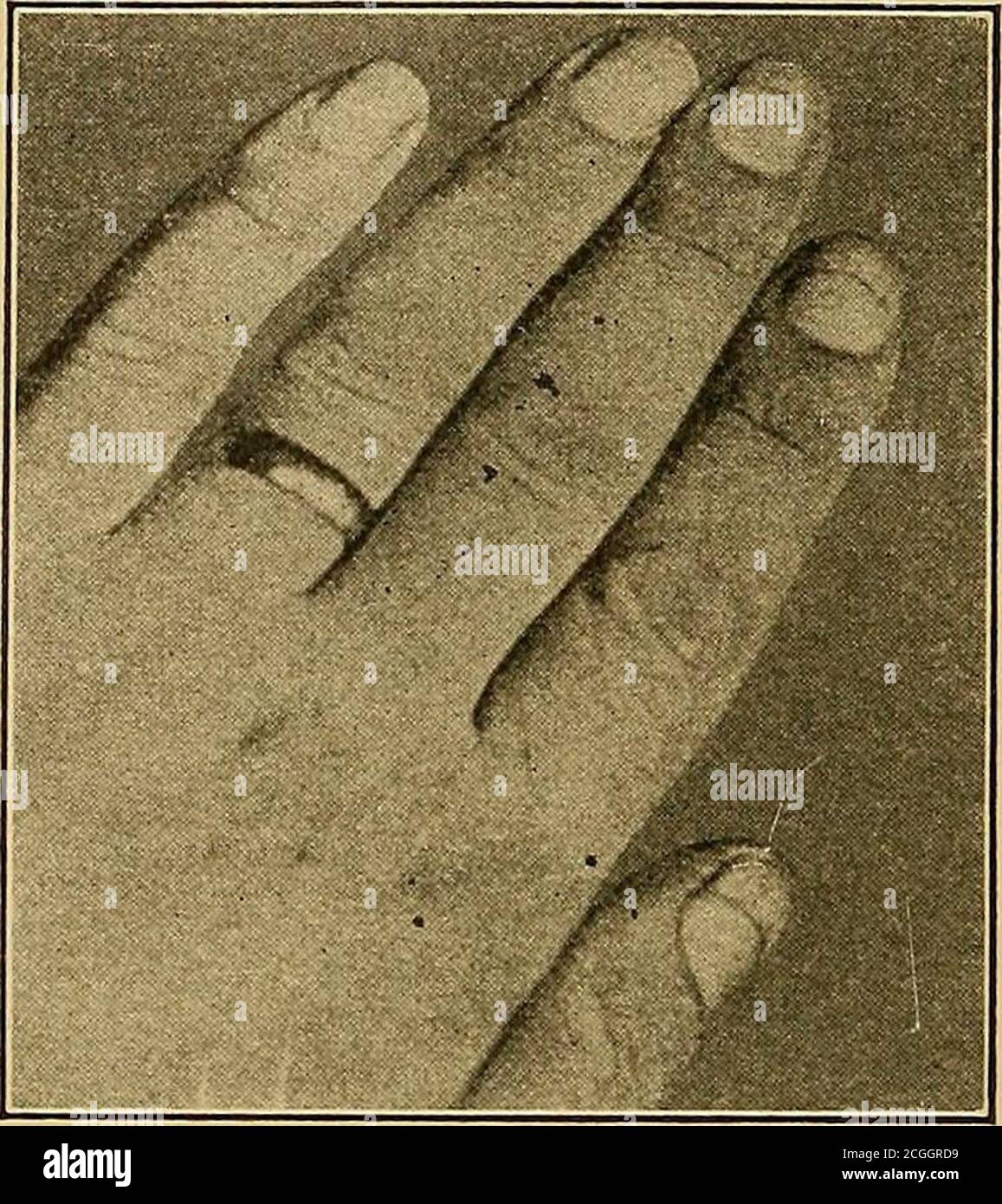 Hang nail infection hi-res stock photography and images - Alamy