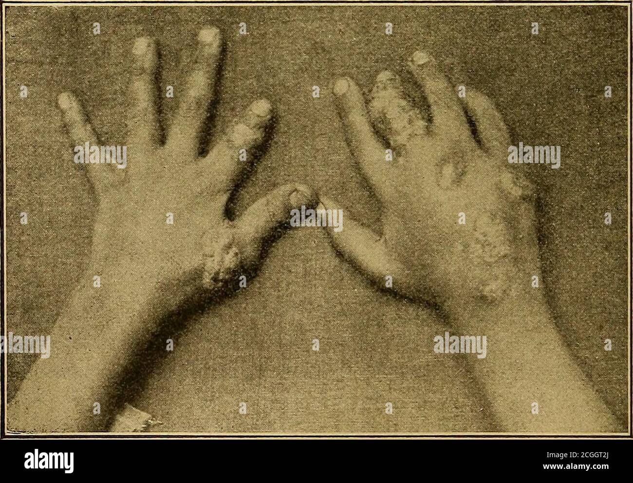 Leprosy Hands High Resolution Stock Photography and Images - Alamy