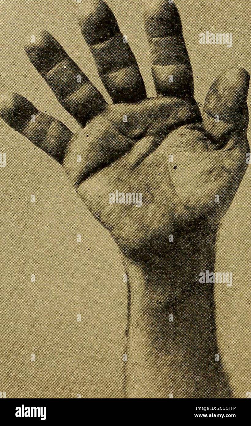 . Physical diagnosis . FIG. 29.—Atrophic Arthritis with Flipper Hand ...
