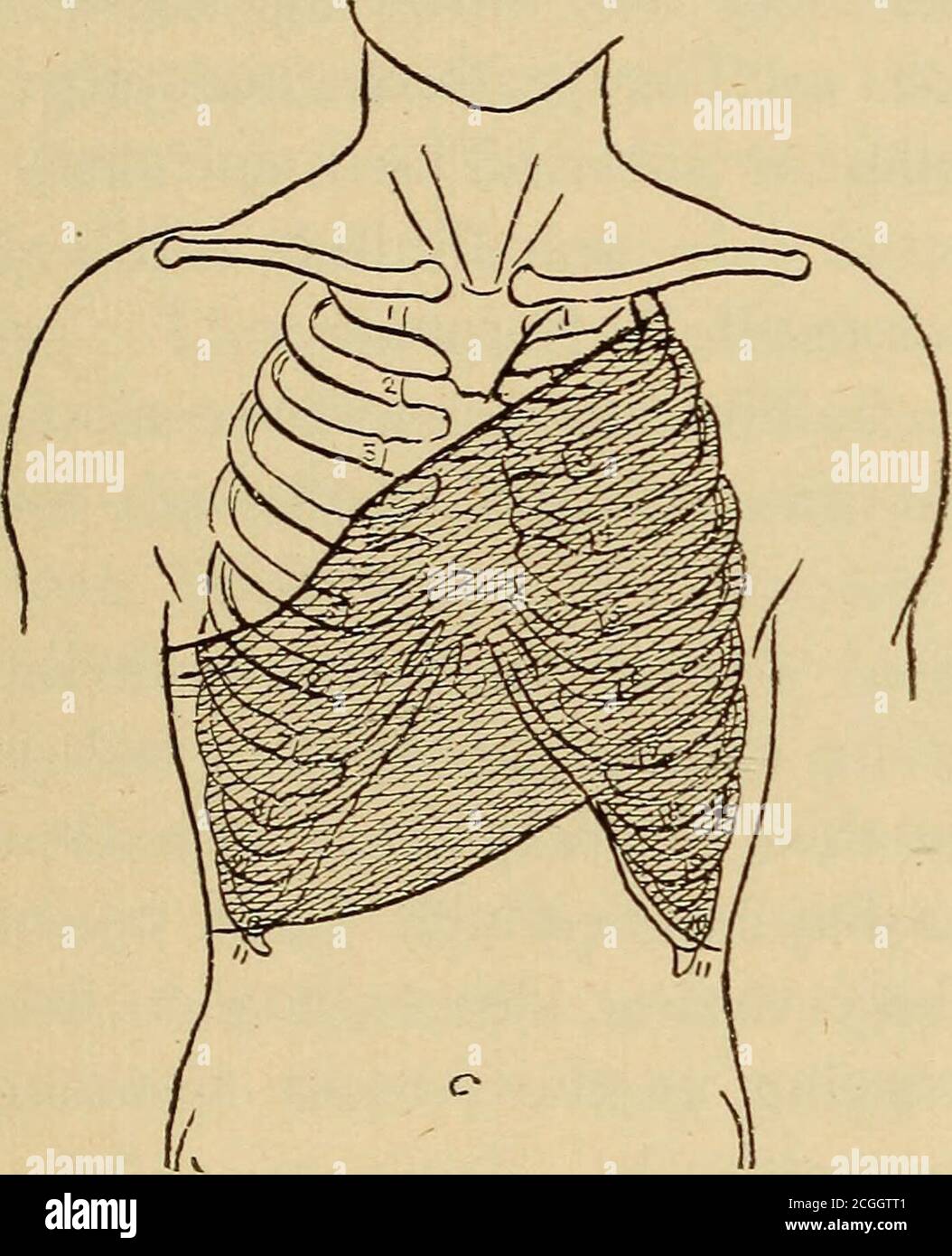 . Diseases of the lungs . sac ishalf filled, the fluid begins to ...