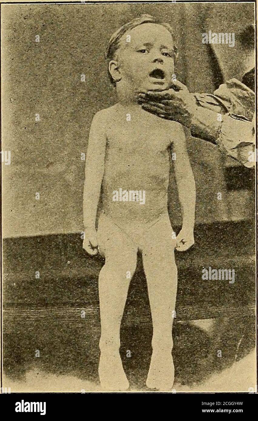 Carbuncle boils hi-res stock photography and images - Alamy