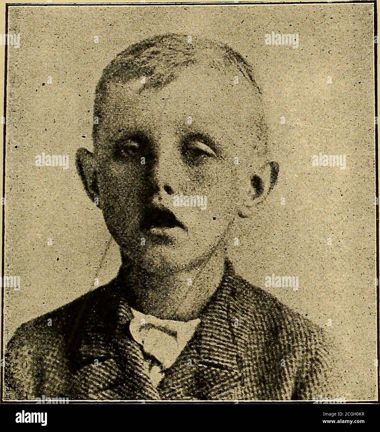 . Physical diagnosis . Fig. 6.—Myxcedema. Fig. 7.- -Cretinism. months ...