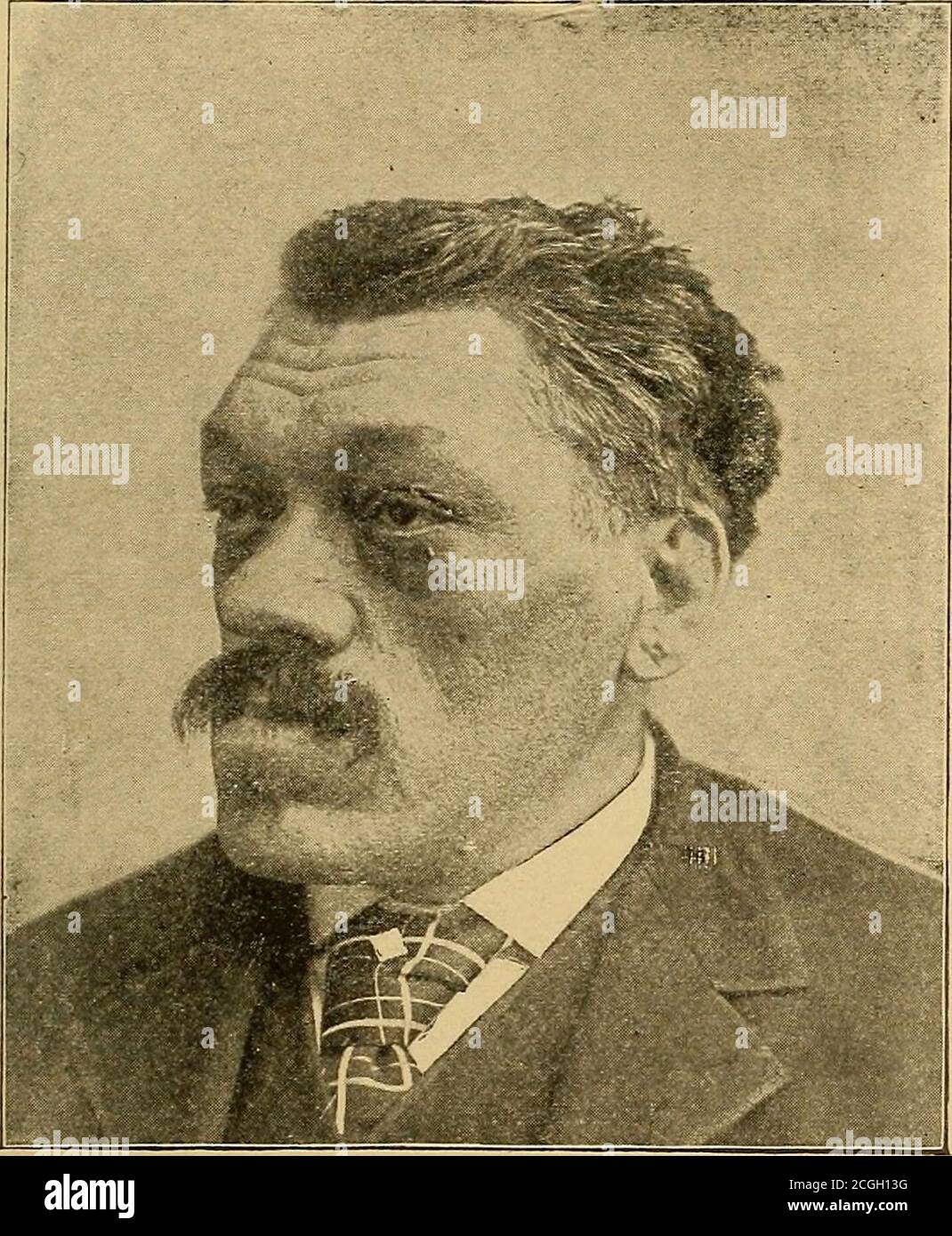 Old syphilis scars hi-res stock photography and images - Alamy