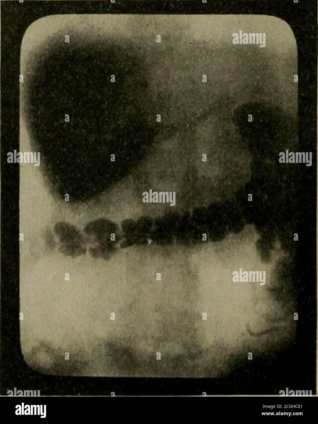 . Hospital Bulletin . s: Ueo-c&ecal spasm. Fig. 4—IS hours: Kinked ...