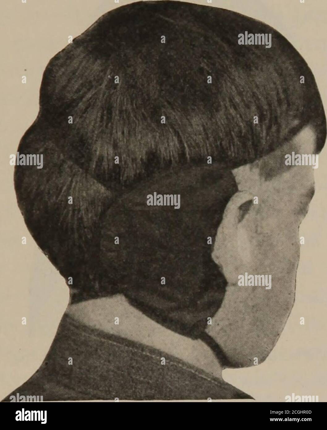 Wound secretion hi-res stock photography and images - Alamy