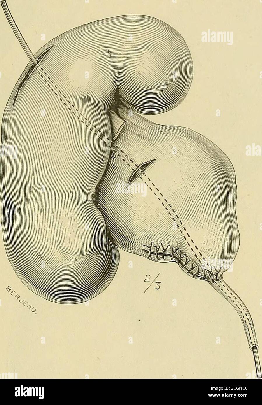 Fistula renal hi-res stock photography and images - Alamy