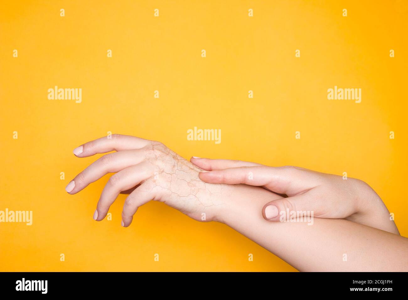 Hands with dry cracked skin, the concept of hand skin problems. Yellow ...
