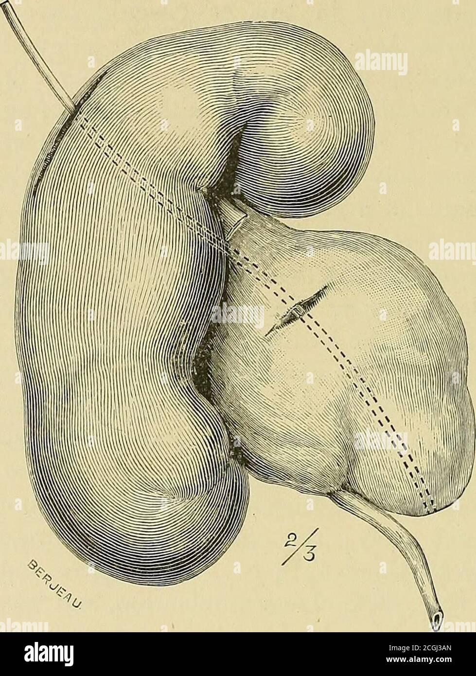 . On the origin and progress of renal surgery, with special reference ...