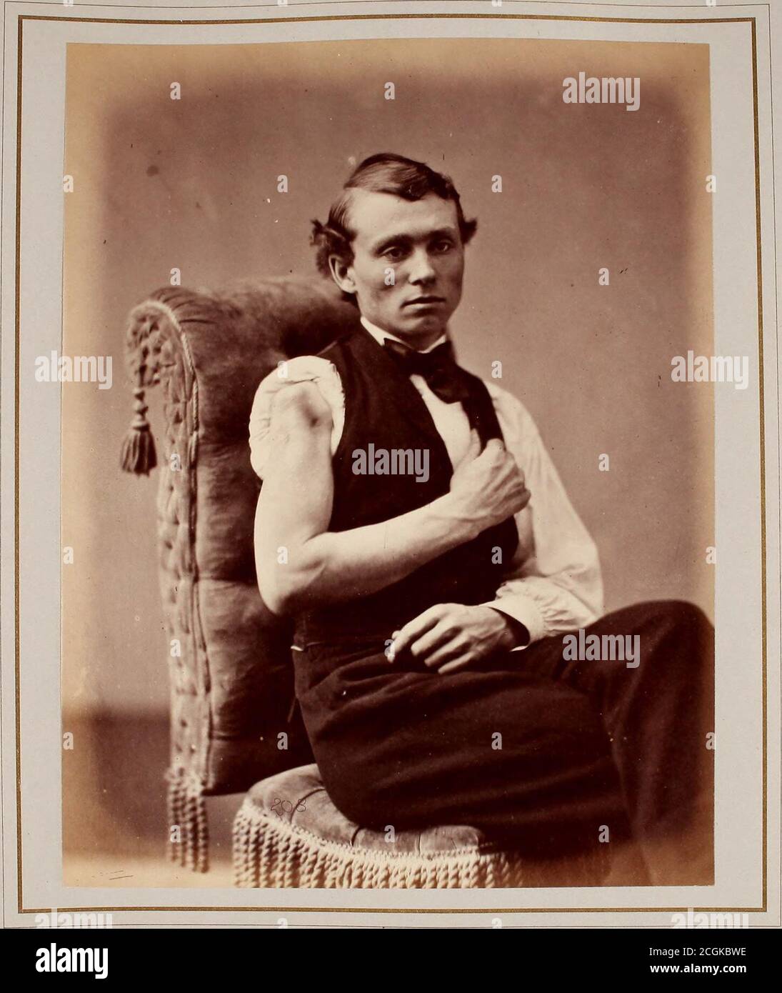 Barrel chest medical hi-res stock photography and images - Alamy