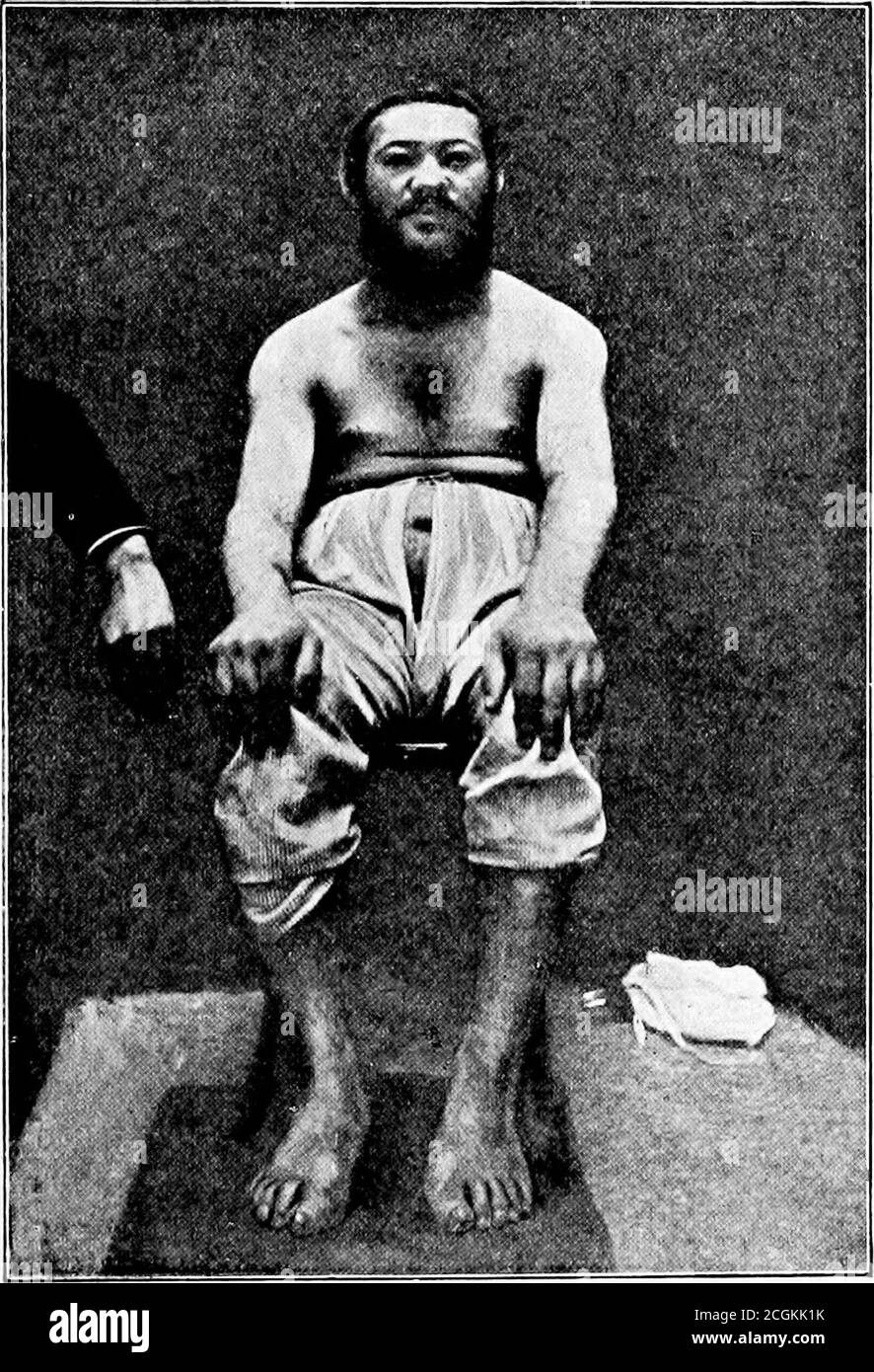 Acromegaly Face