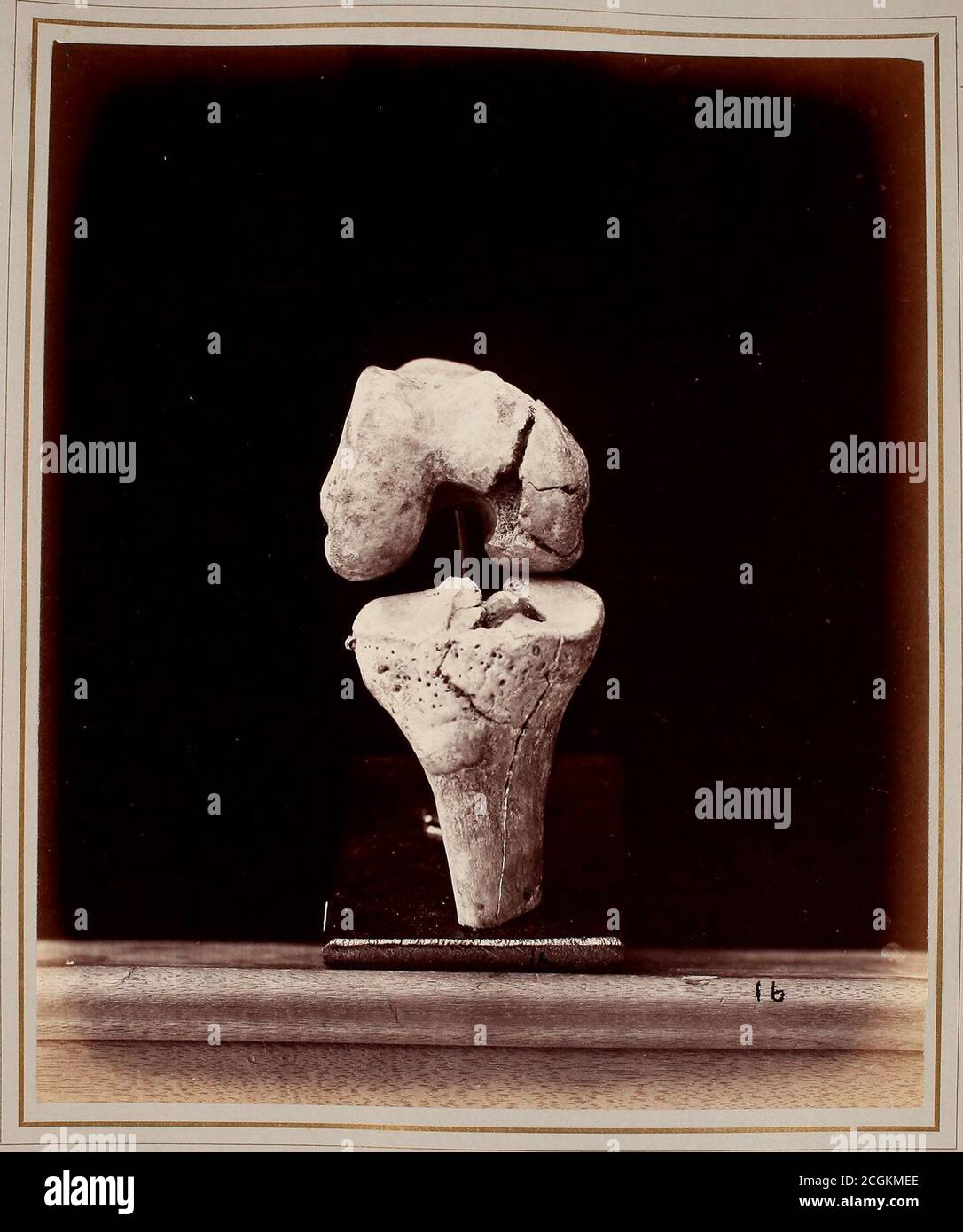 . Photographs of surgical cases and specimens . aft of the humerus, and ...