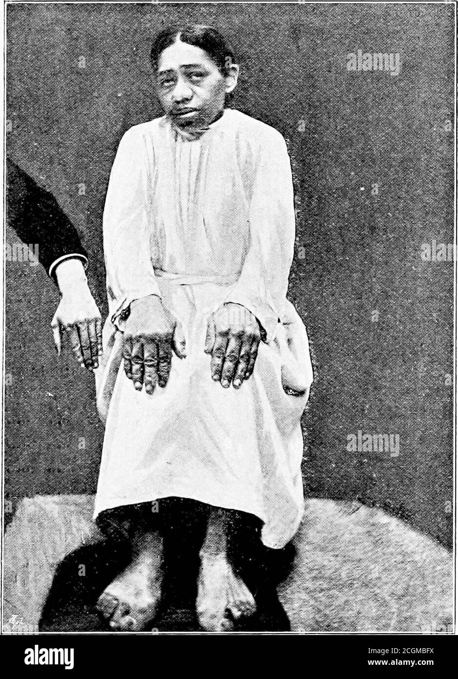 . Acromegaly . f IG. 1. Ilhiftration of a man, about 21 year.s of age ...