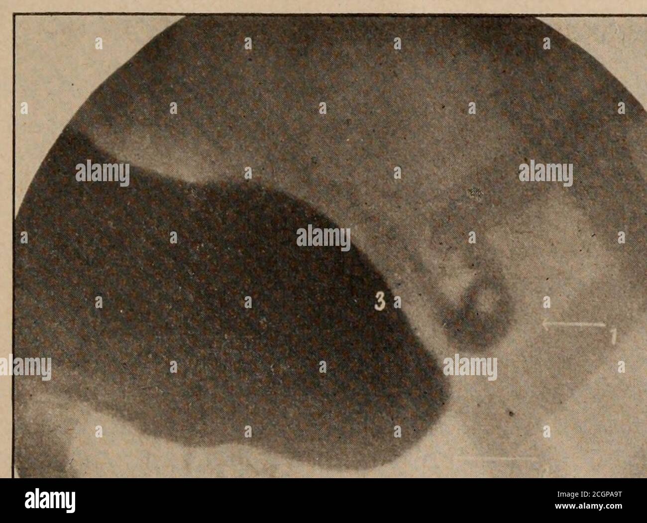 . Buffalo medical journal . Fig. 5.—1. Mass of nearly forty small gall ...