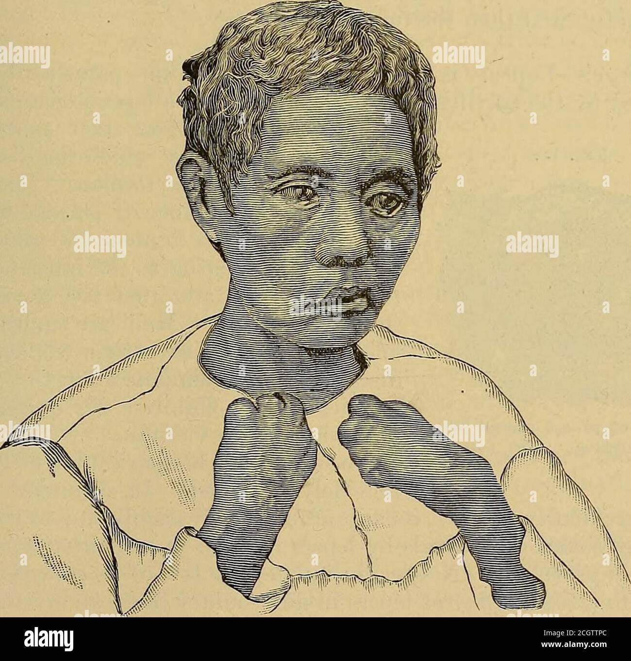 Bullae skin hi-res stock photography and images - Alamy