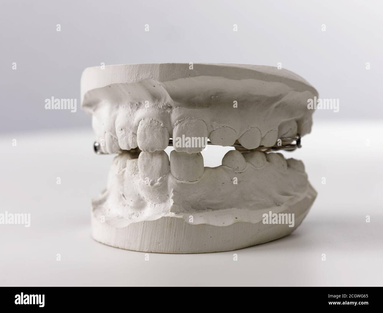 Teeth mold hi-res stock photography and images - Alamy