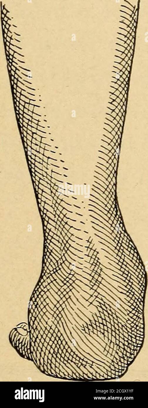. Atlas and epitome of traumatic . Fig. 152.—Compression-fracture of ...