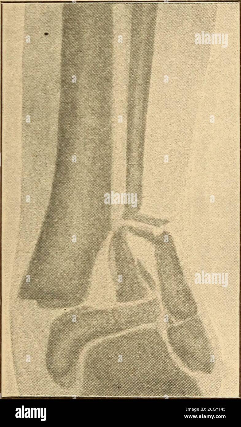 . Atlas and epitome of traumatic . FRACTURES OF THE LOWER EXTREMITY ...