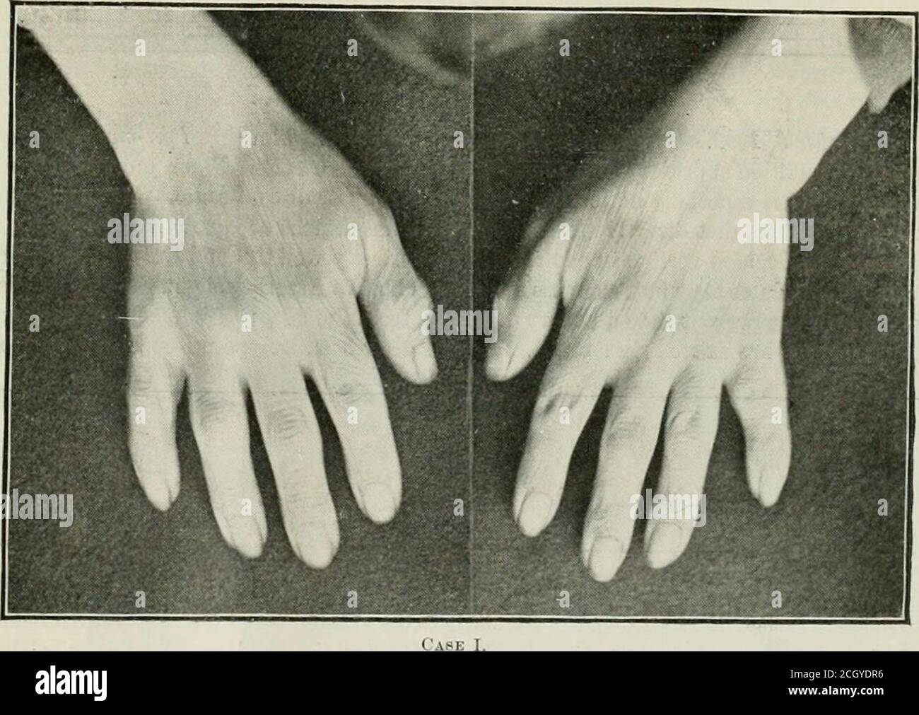 Cyanotic hi-res stock photography and images - Alamy