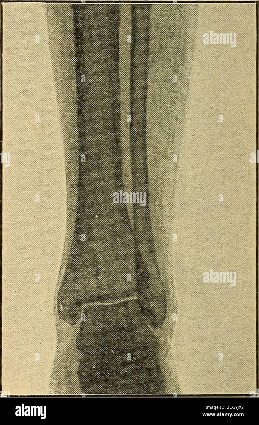 . Atlas and epitome of traumatic . Fig. 149.—Rontgen-ray pictures of a ...