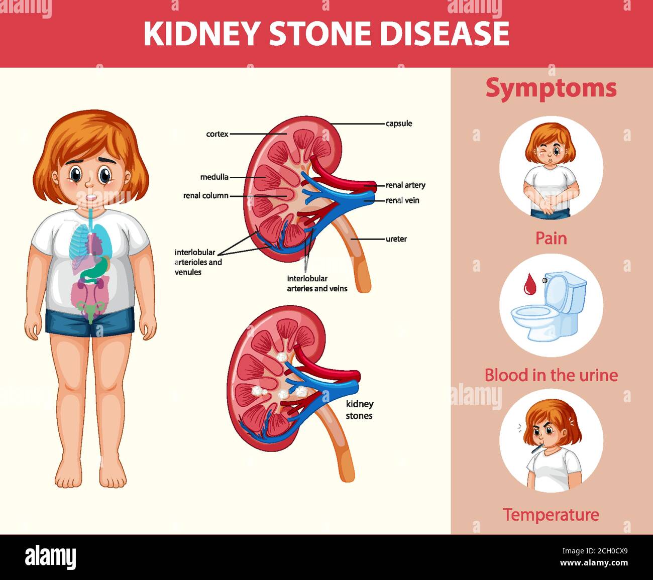 Kidney stones disease cartoon style infographic illustration Stock ...